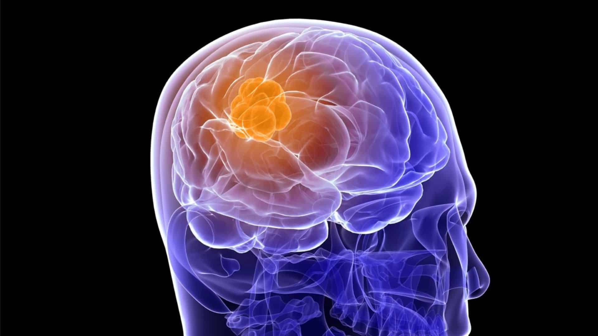 Gliome : Qu'est-ce que c'est ? - Une Poignée d'Amour